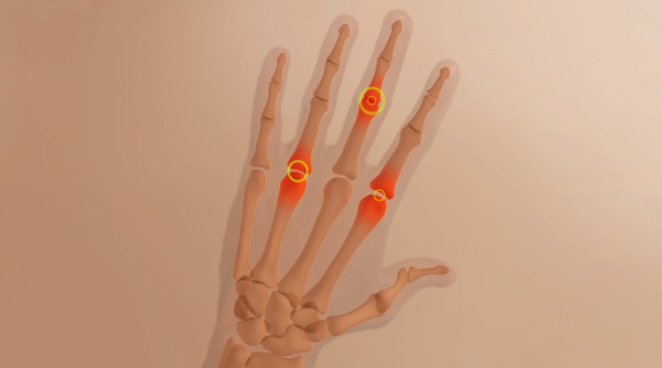 Bill Graham Rheumatoid Arthritis 3d Animation Artists Blogs