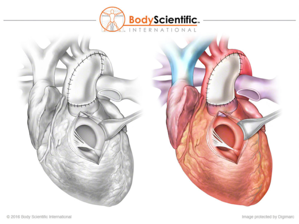Colorization Technique – Artists' Blogs :: Medical Illustration Sourcebook